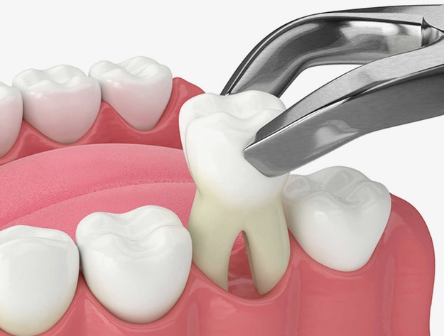 Extraction & Grafting in San Antonio, TX - Life Smiles Dental Studio ...