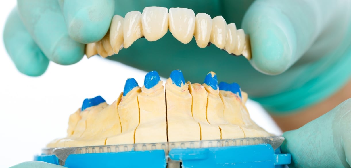 What Should We Do If A Dental Bridge Falls Out