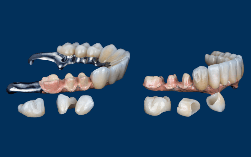 Repairing Or Replacing A Broken Crown