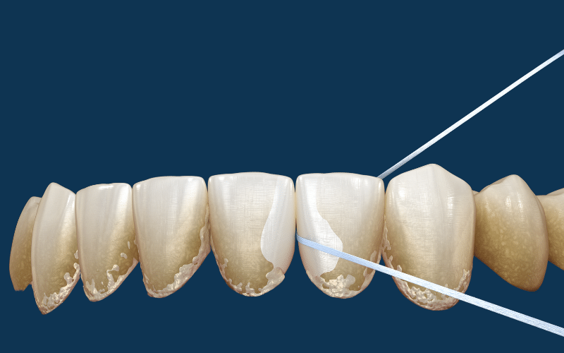 Steps to Remove Plaque & Tartar From Teeth