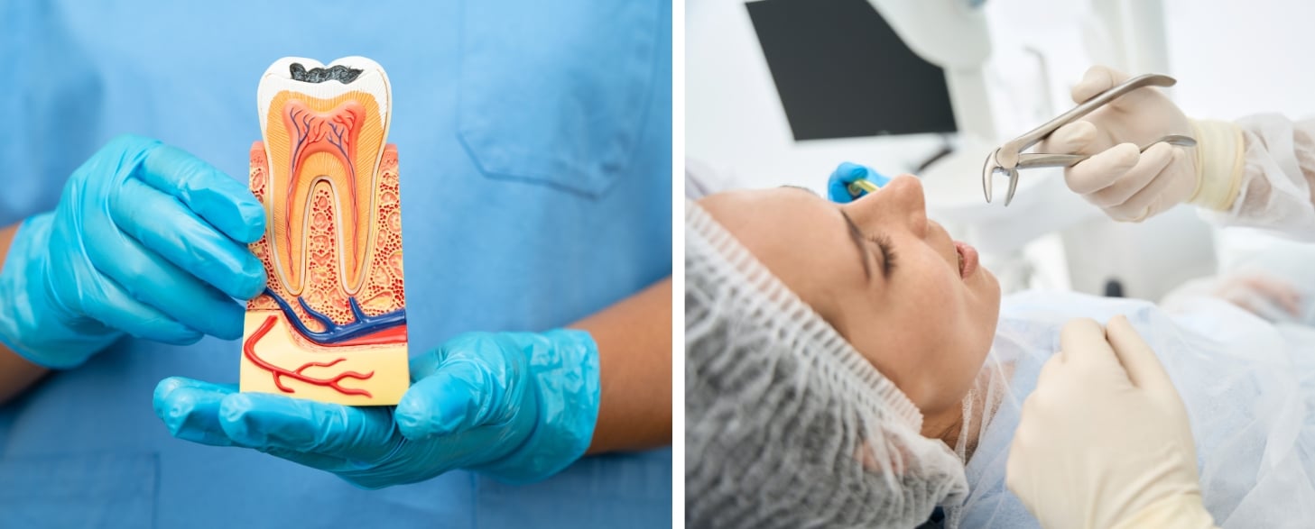 Understanding the Removal of a Nerve from a Tooth