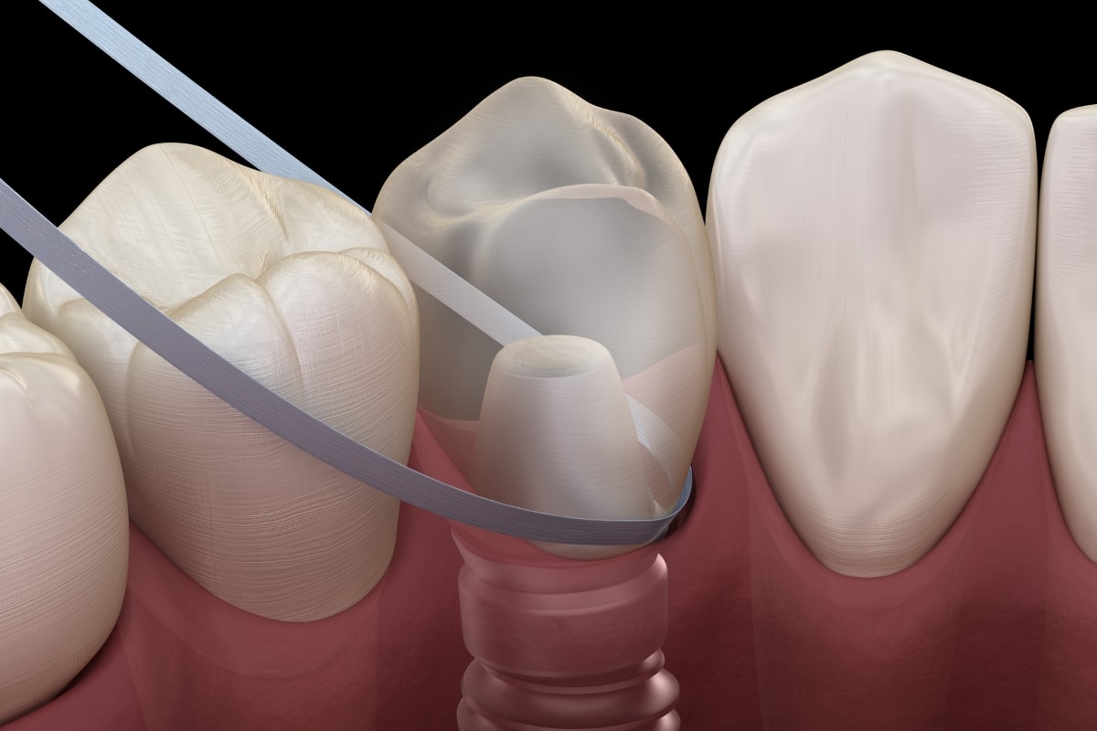 Floss with Dental Implants: Essential Tips You Need